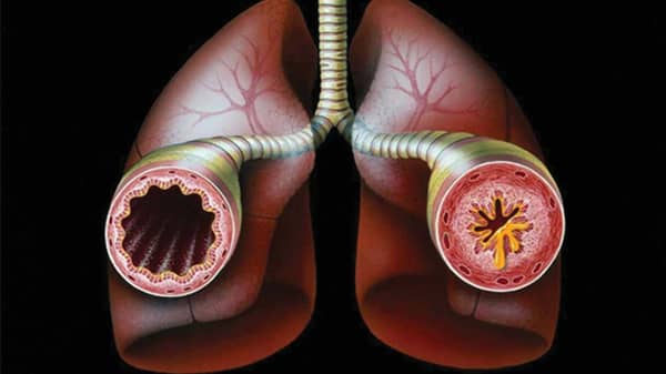 asthma constriction bronchioles